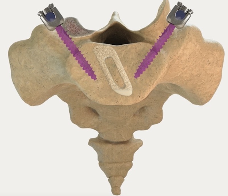 Product-detail | NeuroSpine