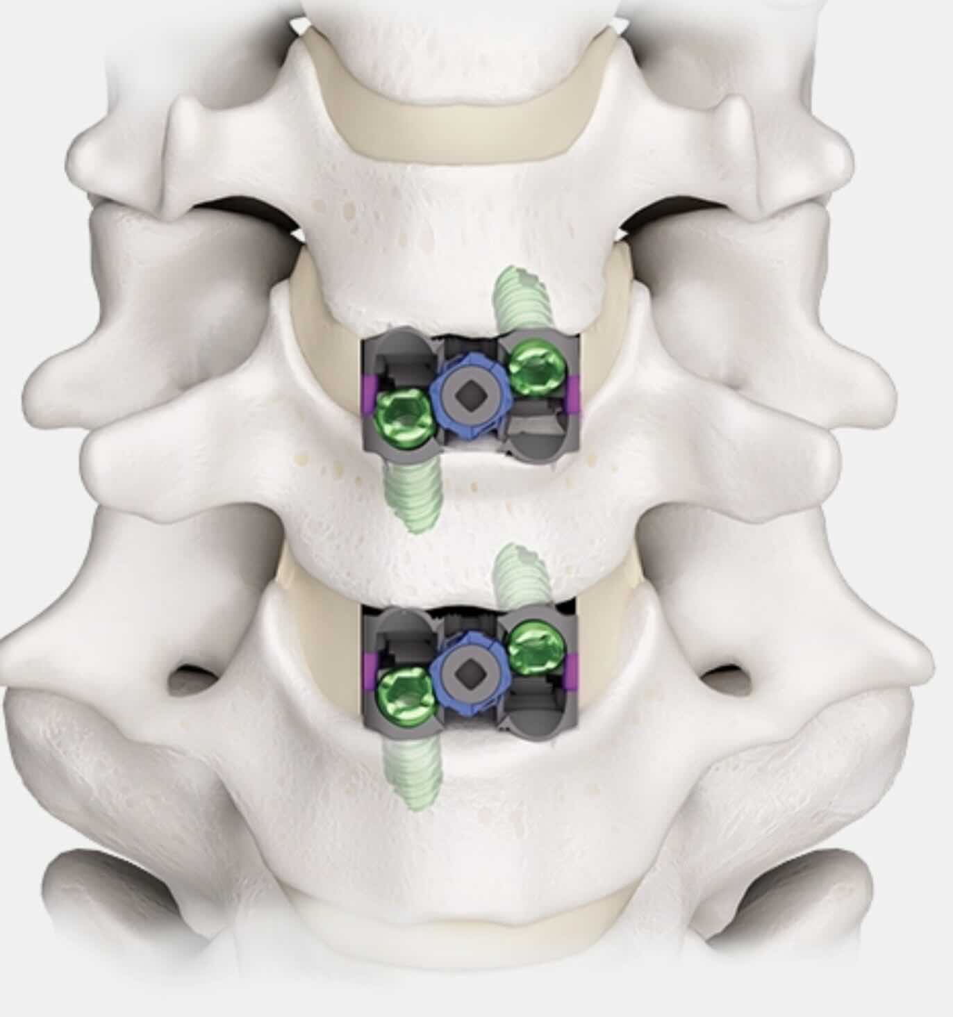 Product-detail | NeuroSpine